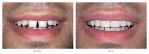 Dentist Atlanta GA | Midtown Implants, Veneers | Feather Touch Dental