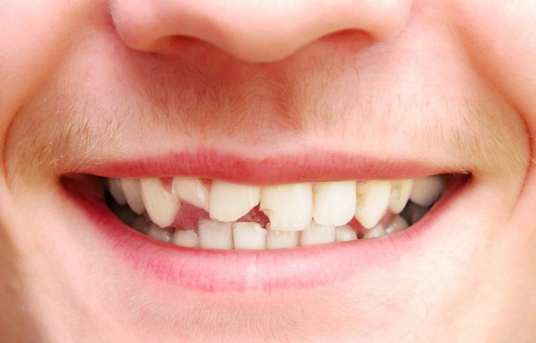 Treatment for Chipped Teeth - Atlanta, GA